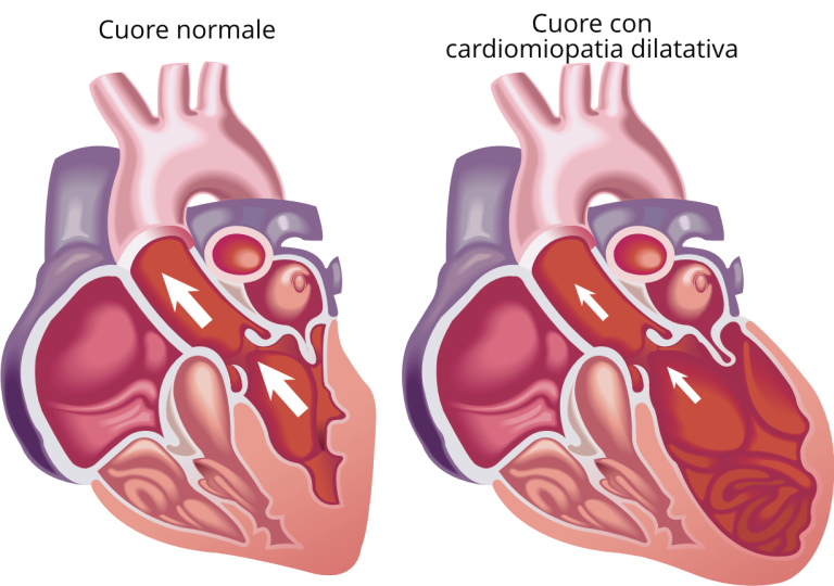 Salute e benessere: Cardiomiopatia dilatativa